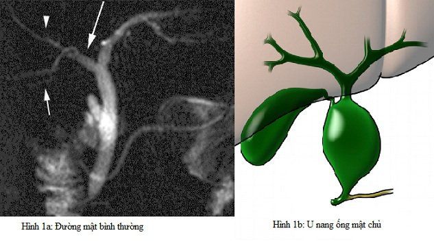 Common Bile Duct Cyst Gs Dr Nguyen Thanh Liem Vinmec