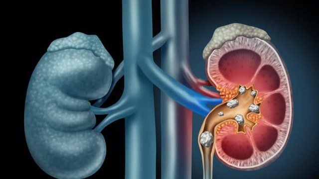 How is a 3mm kidney stone treated? | Vinmec
