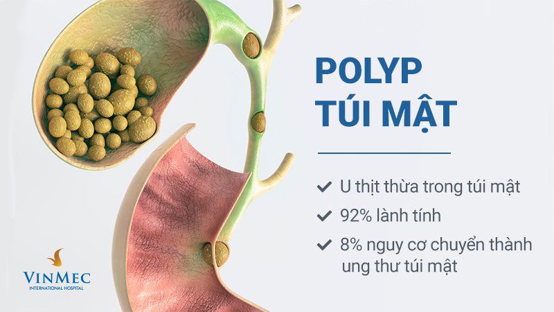 Do gallbladder polyps go away on their own? When to have surgery? | Vinmec