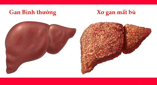 Triệu chứng xơ gan mất bù | Vinmec