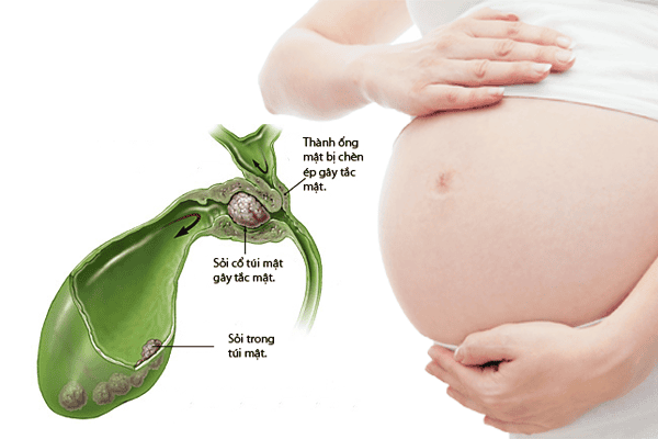 Gallbladder stones during pregnancy: What you need to know | Vinmec