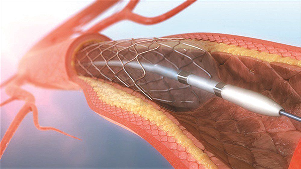 Ưu điểm của kỹ thuật chụp, nong và đặt stent động mạch vành | Vinmec