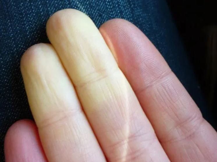 Điều trị hội chứng Raynaud | Vinmec
