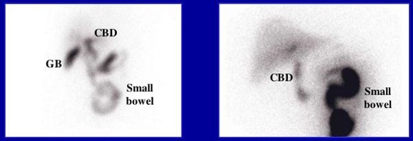 HIDA scan: Ứng dụng và những điều cần biết | Vinmec