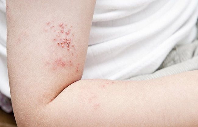 Does shingles leave scars after it heals? | Vinmec