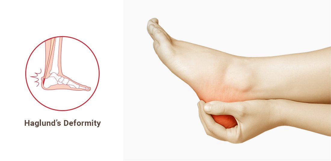 Tìm hiểu thông tin về Bệnh Haglund | Vinmec