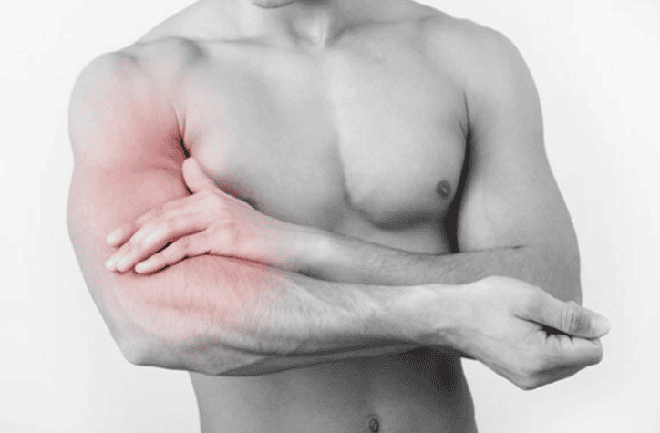 Hội chứng tiêu cơ vân cấp | Vinmec