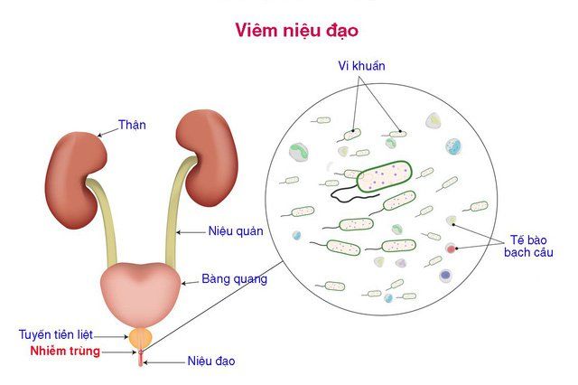 Gonococcal Urethritis: Essential Information | Vinmec