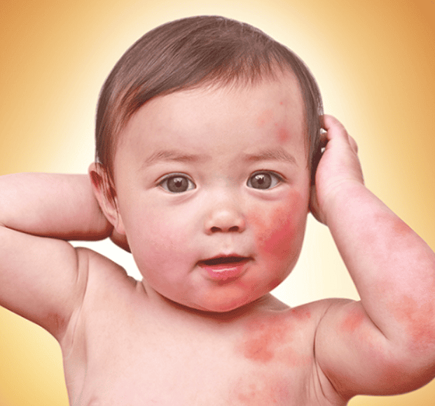 Bệnh Lupus ban đỏ sơ sinh: Những điều cần biết | Vinmec
