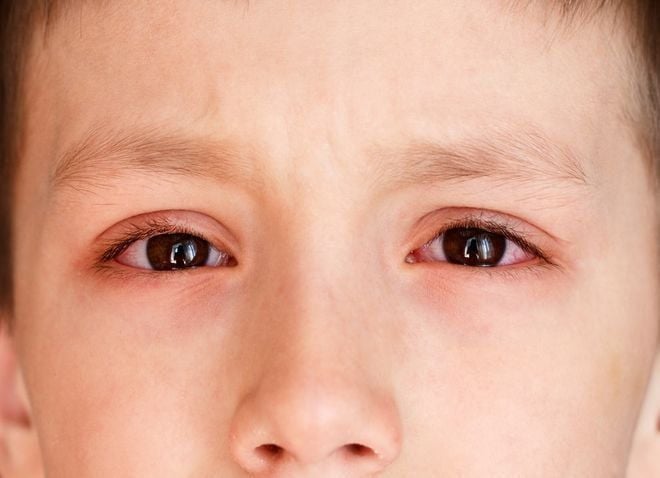 How does lupus affect the eyes? | Vinmec