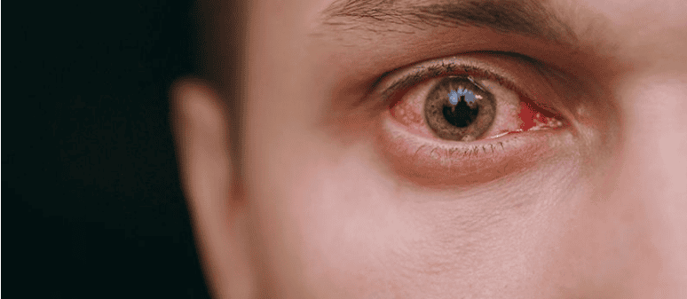 Hướng dẫn cách điều trị và chăm sóc viêm màng bồ đào | Vinmec