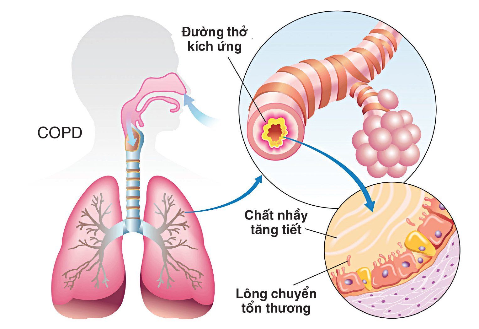 COVID pandemic: Cautions if you detect mucus in your chest | Vinmec