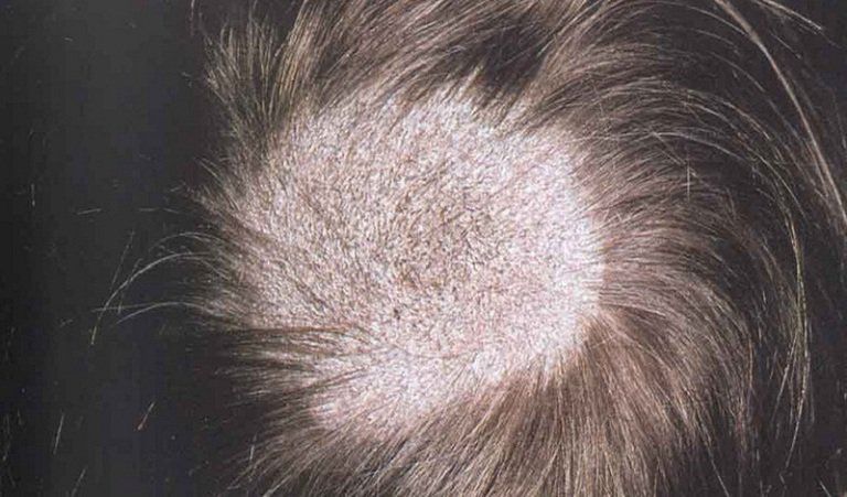 Tinea Capitis: Causes, Symptoms, and Treatment | Vinmec