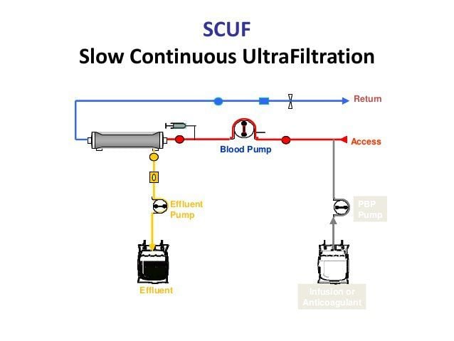 Siêu lọc máu chậm liên tục (SCUF) | Vinmec
