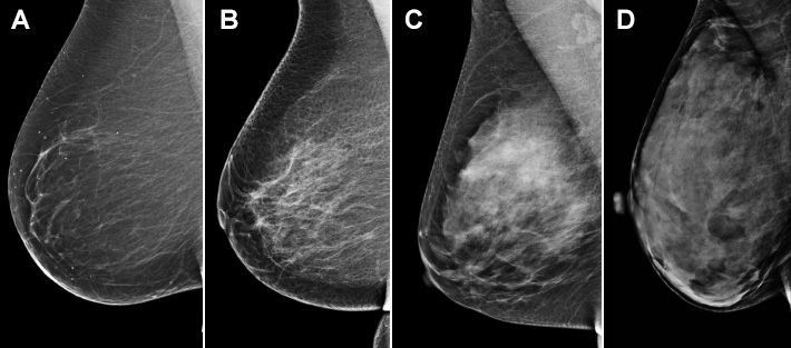 Ý nghĩa của bảng phân loại BI-RADS trên kết quả thăm khám vú | Vinmec