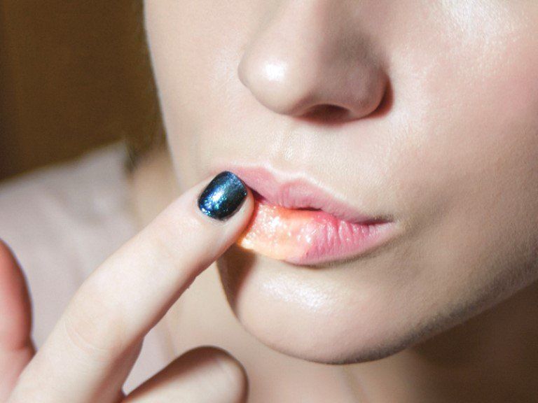 Swollen Lips in the Morning: Common Causes, Effective Treatments, and ...