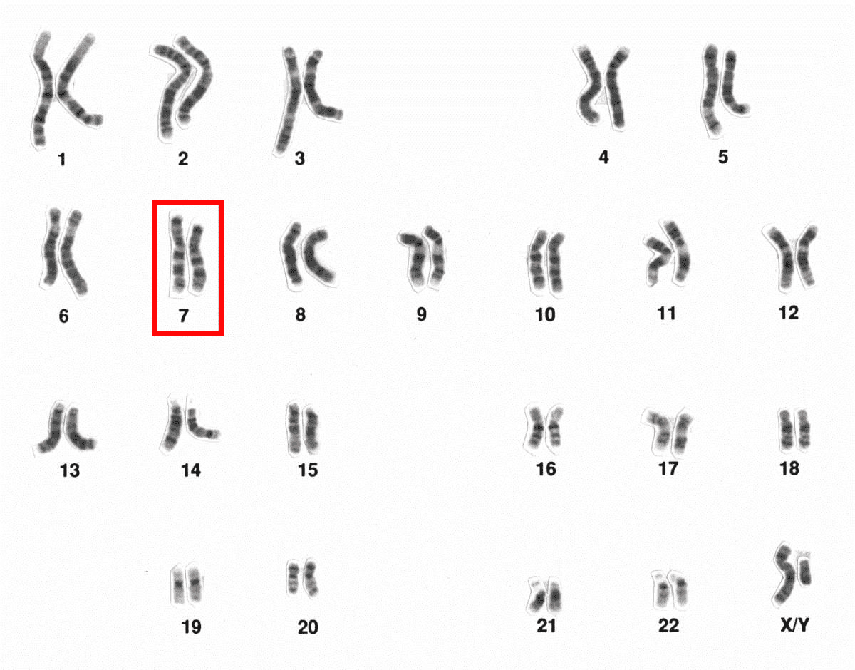Chromosome 7, Partial Monosomy 7p: Những điều cần biết | Vinmec