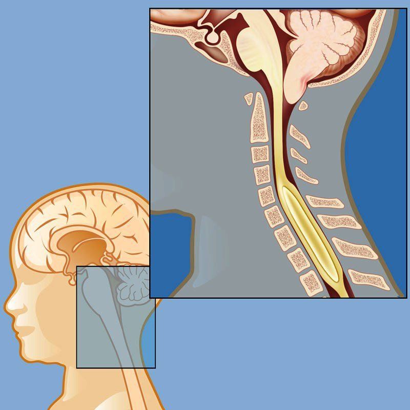Hội chứng Arnold Chiari có nguy hiểm? | Vinmec