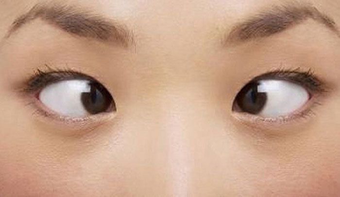 Nguyên nhân mắt bị lác là gì? | Vinmec
