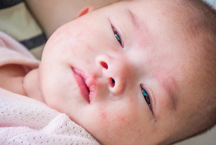 Why do children develop rashes without a fever? | Vinmec