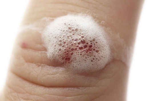 Should you use hydrogen peroxide on your skin? | Vinmec