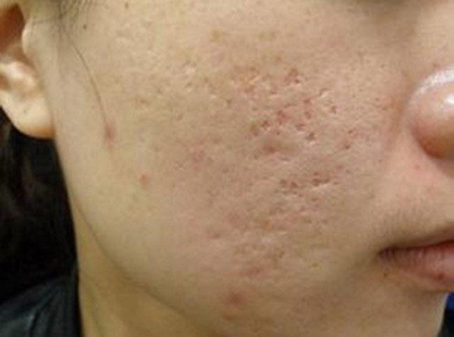 Điều trị sẹo rỗ ở mặt thế nào? | Vinmec