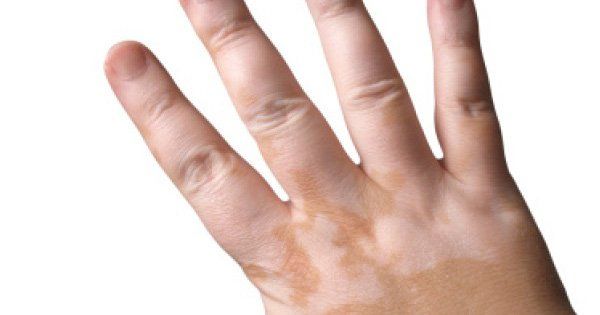 How to treat tinea versicolor in children. | Vinmec