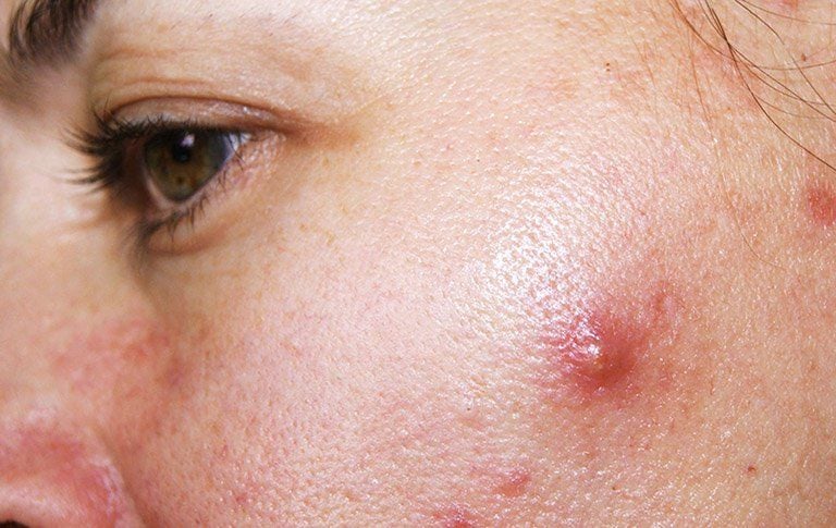 Distinguishing between common pimples and skin cancer | Vinmec