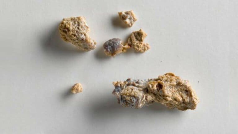 Are 8mm kidney stones dangerous? | Vinmec