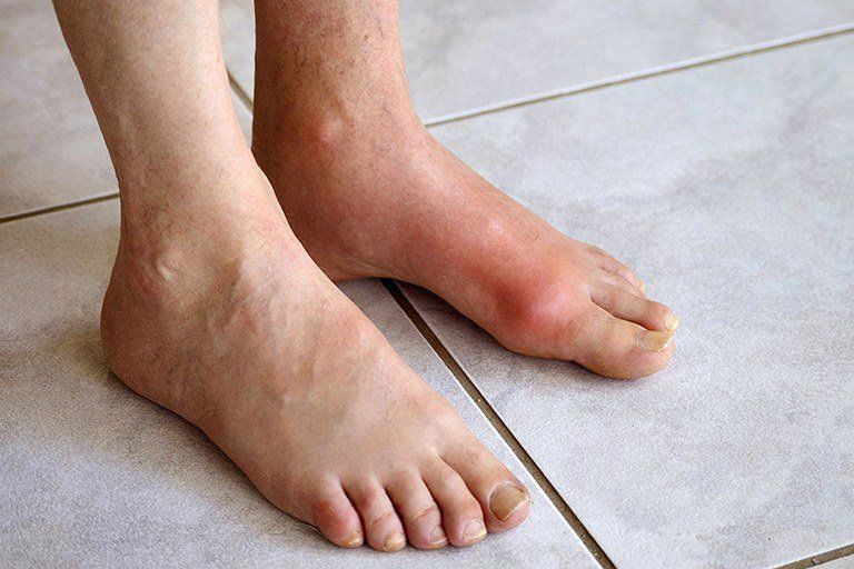 Bệnh gout mãn tính: Cách chung sống với bệnh hiệu quả | Vinmec