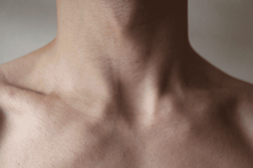 Is a swollen lymph node in the collarbone dangerous? | Vinmec