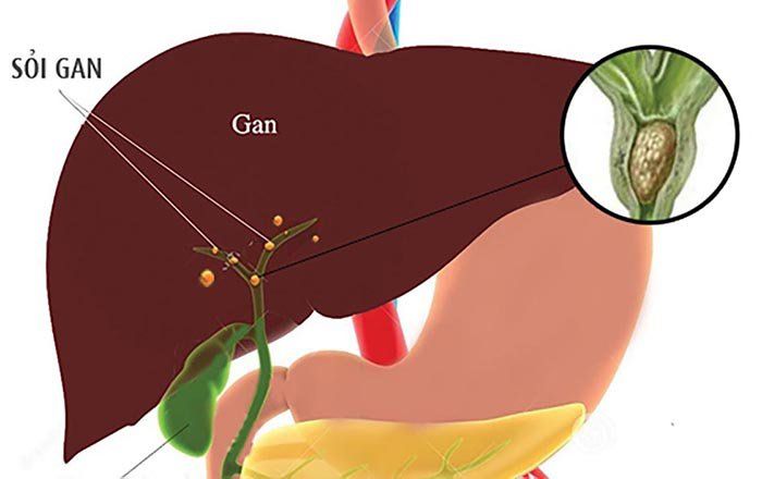 Are Liver Stones Dangerous? | Vinmec