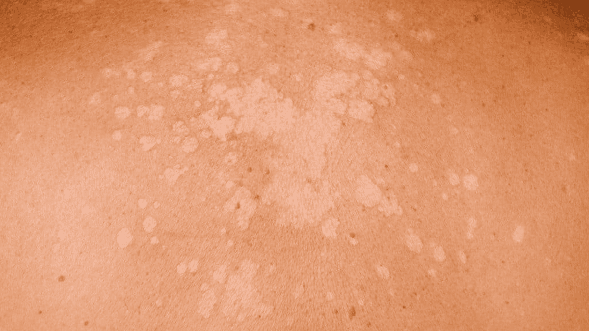 Bị lang beng bôi thuốc gì? | Vinmec