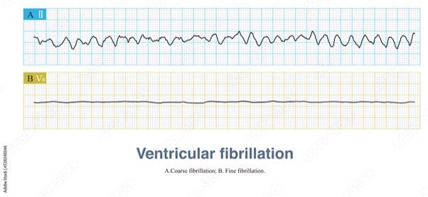 Rung tâm thất sóng lớn và rung tâm thất sóng nhỏ là gì? | Vinmec