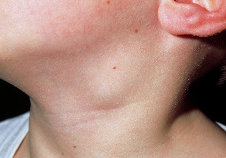 Common sites of swollen lymph nodes | Vinmec