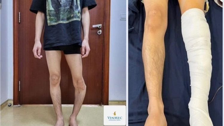 "Straightening" the lower leg for a patient with a foot deformity angle ...