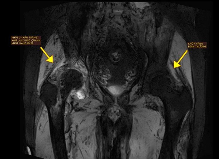 Vietnamese doctors and engineers designed artificial bones to perform ...