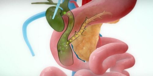 Phẫu thuật nội soi cắt nang ống mật chủ, nối ống gan chung - hỗng tràng