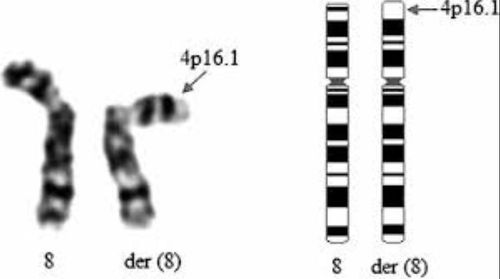 Nhiễm sắc thể 8, Monosomy 8p