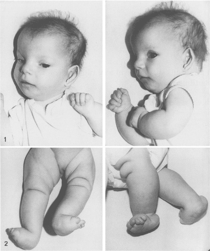 Bất thường nhiễm sắc thể số 9 (Tetrasomy 9P)