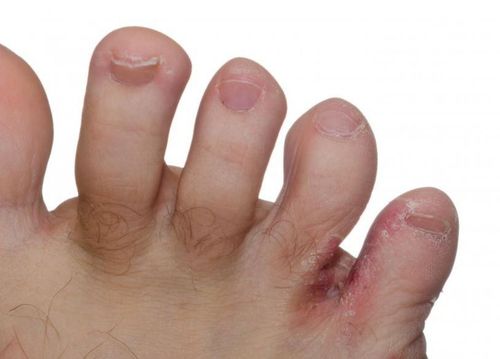 Thuốc Fungoid-D: Công dụng, chỉ định và lưu ý khi dùng